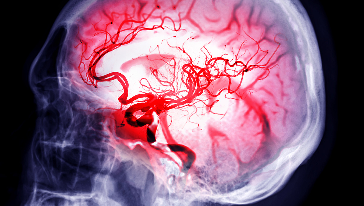 RAISE: Reteplase May Be Another Option for Stroke Thrombolysis | tctmd.com
